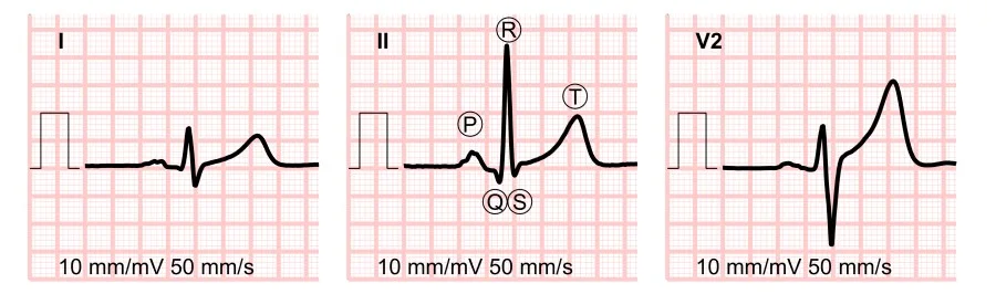 The Normal Ecg Tracing Download Scientific Diagram